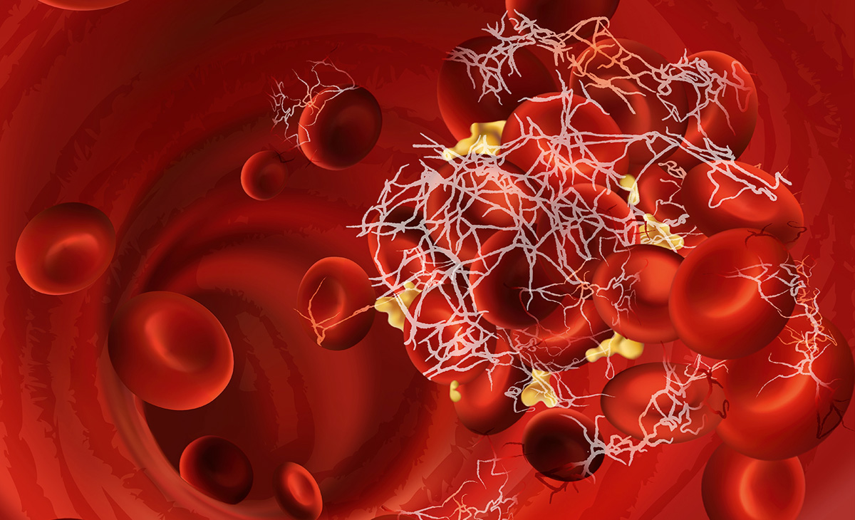 Individualizirani pristup bolesniku na antikoagulantnoj terapiji