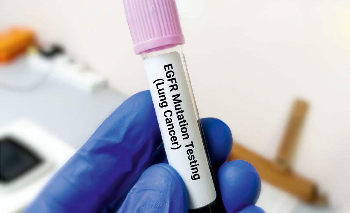 Ciljane terapije u liječenju raka pluća