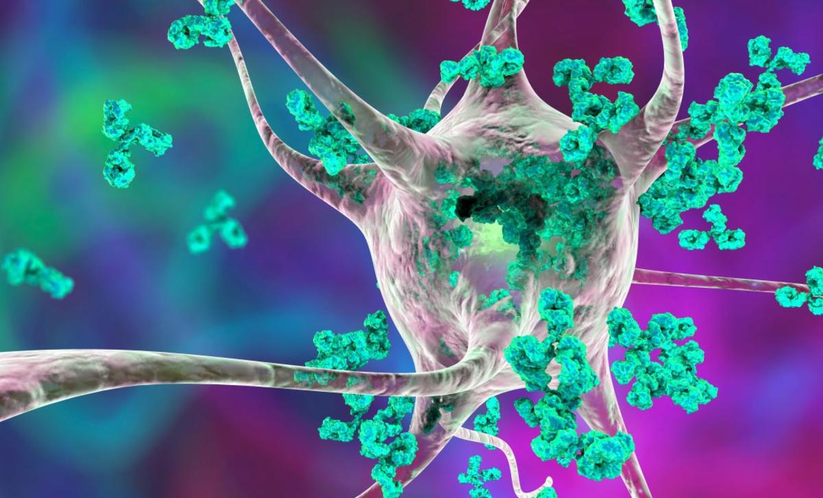 Spektar poremećaja optičkog neuromijelitisa (NMOSD): rijetka, ali ...