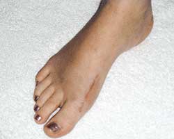 Nova metoda za naravnanje kosti pri nožnem palcu