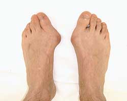 Nova metoda za naravnanje kosti pri nožnem palcu