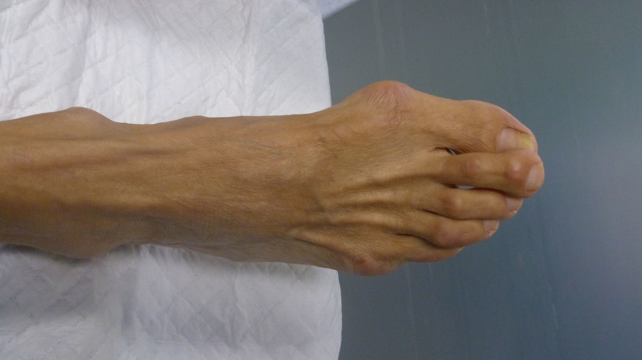 Hallux valgus: kdaj je smiselno operirati deformiran palec na nogi?