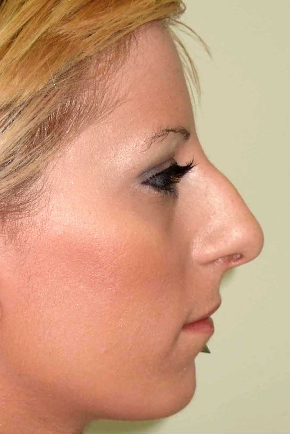 Fotoreportaža: Estetsko-funkcionalna operacija nosu