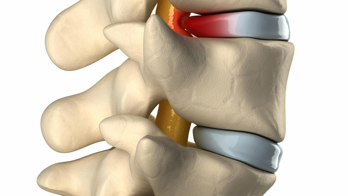 Vas boli križ ali noga? Morda imate zdrs medvretenčne ploščice ...