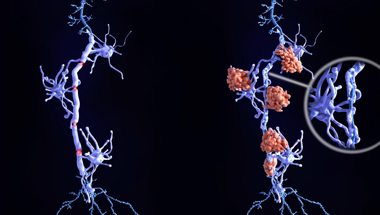 Multipla skleroza kaže vse prijaznejši obraz