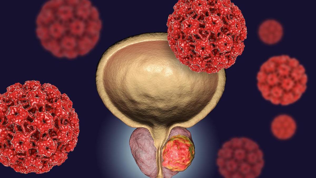 Učinkovitejše prepoznavanje raka prostate